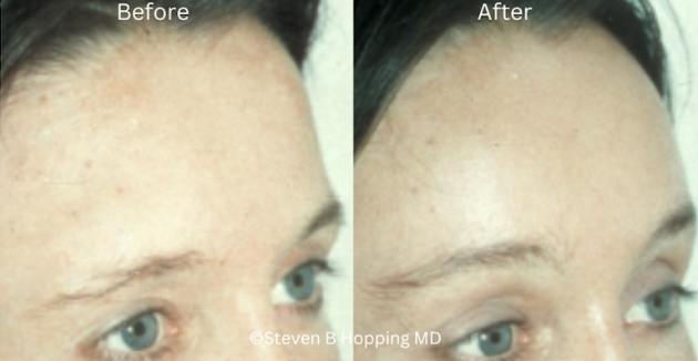 Minimal Incision/Endoscopic Forehead Brow Lift - Cosmetic Surgery ...