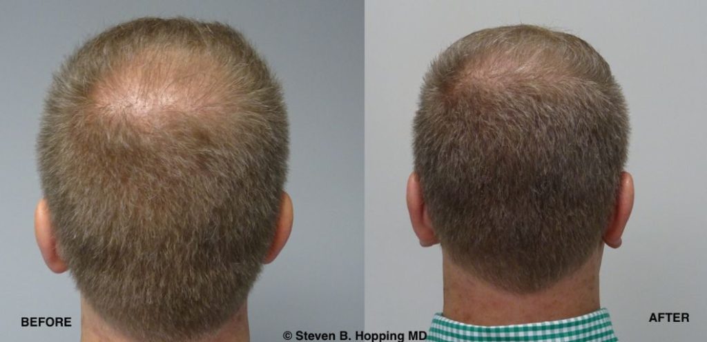 PRP for Hair Loss - Cosmetic Surgery, Plastic Surgery, Aesthetic Laser ...