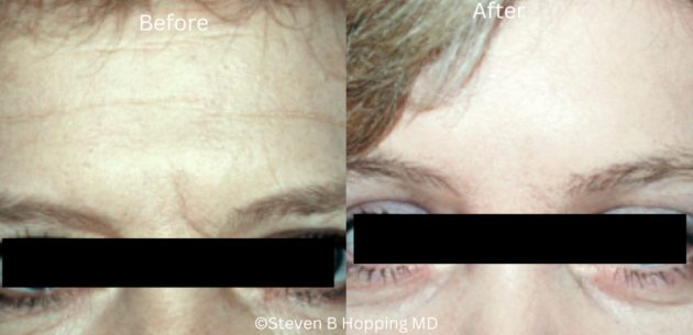 Trichophytic/Hairline Forehead/Brow Lift - Cosmetic Surgery, Plastic ...