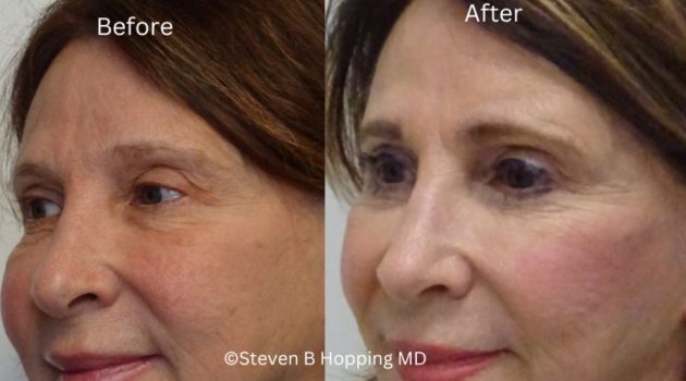 Temple Brow Lift - Cosmetic Surgery, Plastic Surgery, Aesthetic Laser ...