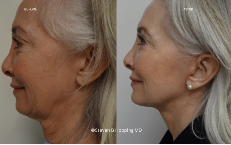 Mini Facelift - Cosmetic Surgery, Plastic Surgery, Aesthetic Laser ...