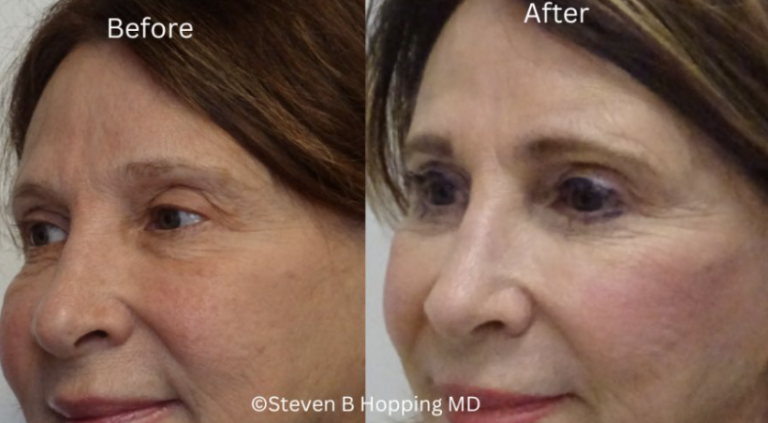 Eyes & Brows Implants - Cosmetic Surgery, Plastic Surgery, Aesthetic ...