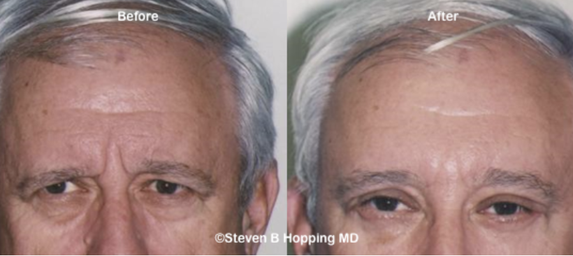 Eyes & Brows Implants - Cosmetic Surgery, Plastic Surgery, Aesthetic ...